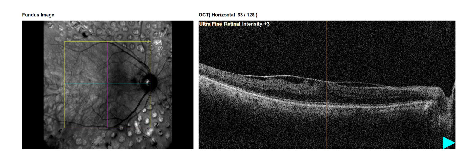 Epiretinal Membran Nedir? - PROF. DR. NUR ACAR Epiretinal Membran Nedir? - PROF. DR. NUR ACAR
